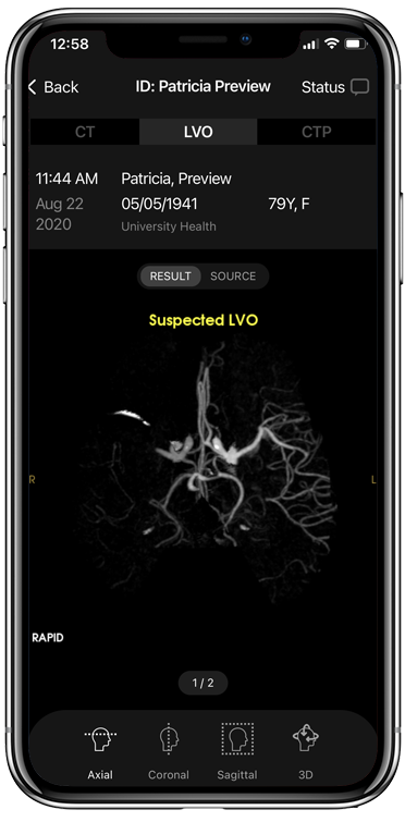 Stroke Patient Care | Rapid Stroke